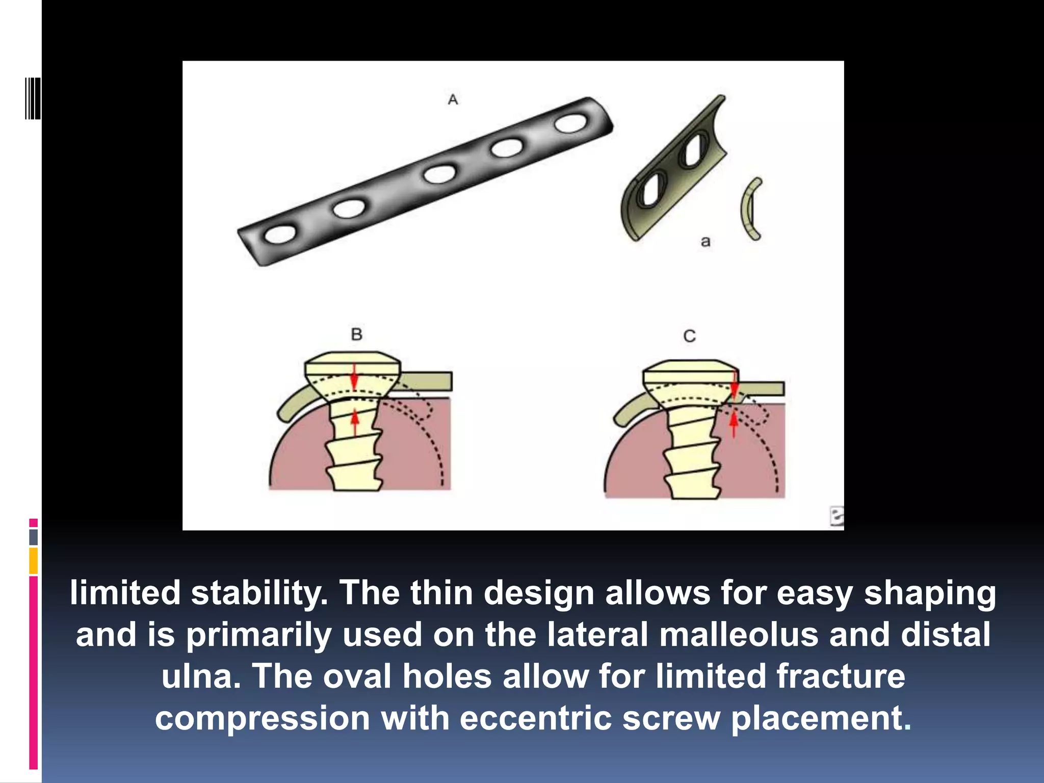 Plates and screws 11 | PPTX