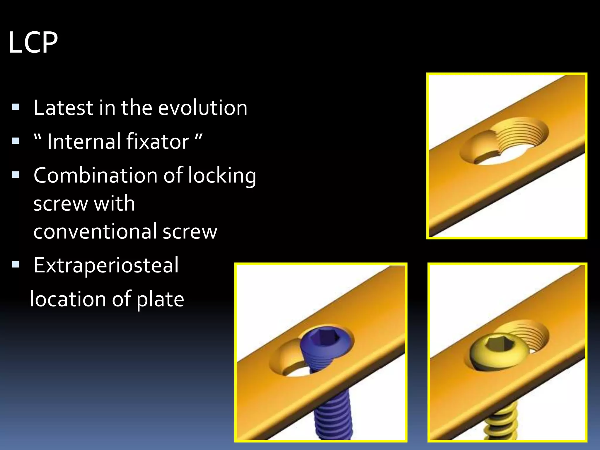 Plates and screws 11 | PPTX