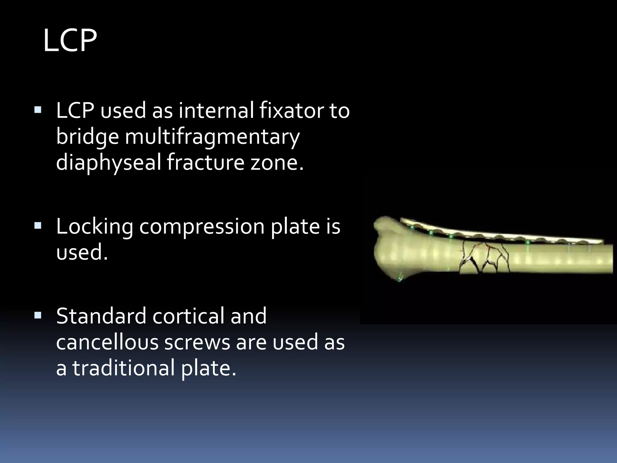 Plates and screws 11 | PPTX