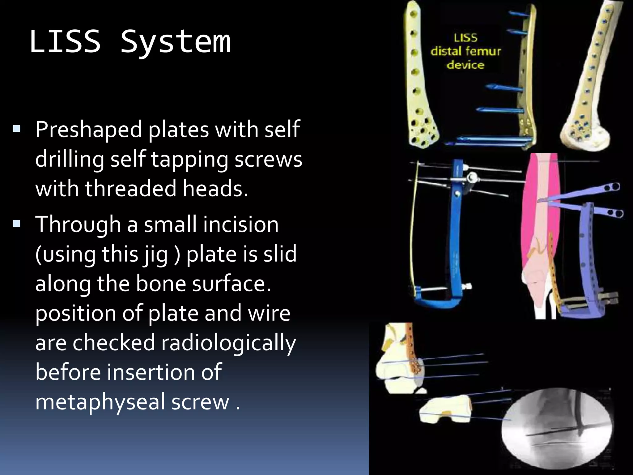 Plates and screws 11 | PPTX