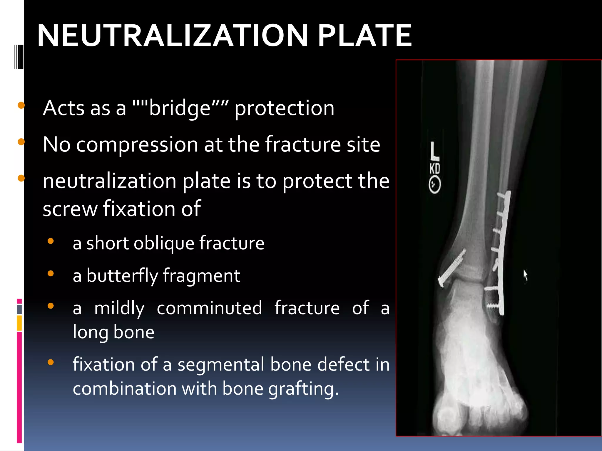 Plates and screws 11 | PPTX