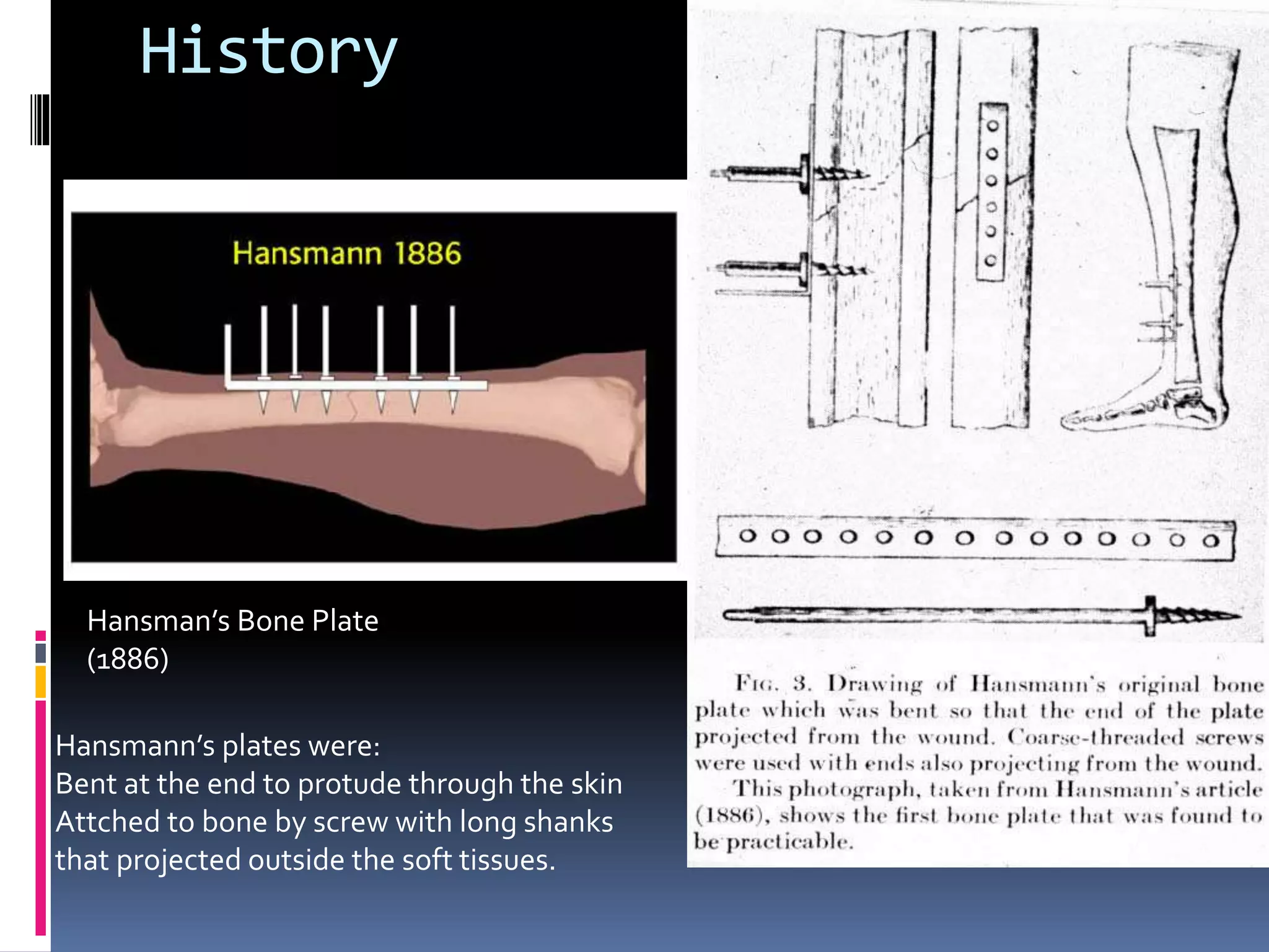Plates and screws 11 | PPTX