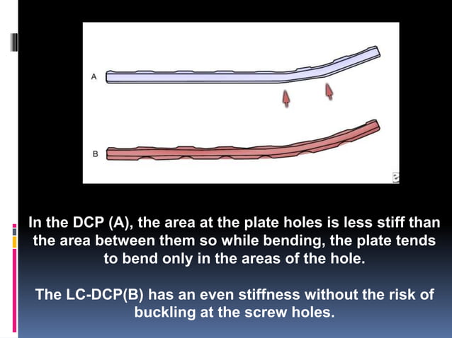Plates and screws 11 | PPTX