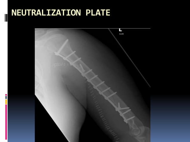 Plates and screws 11 | PPTX