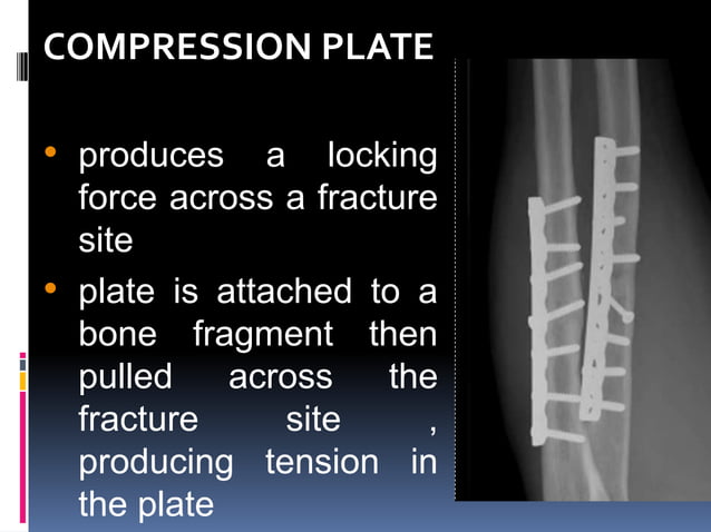 Plates and screws 11 | PPTX