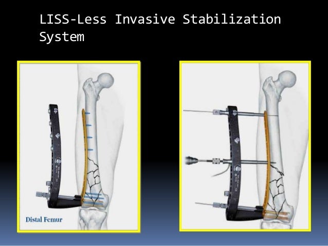 Plates and screws 11