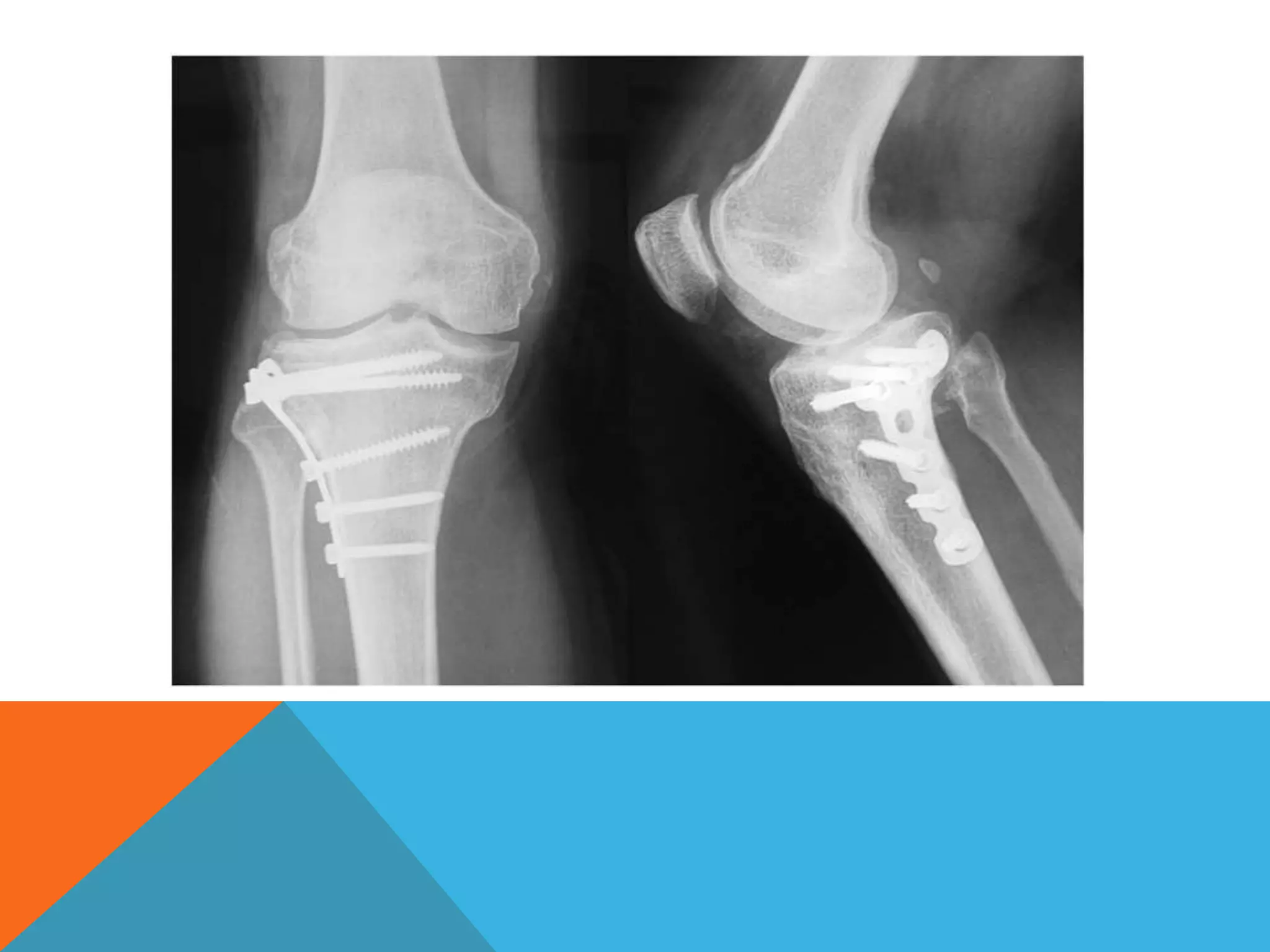 Plates in orthopaedics.pptx