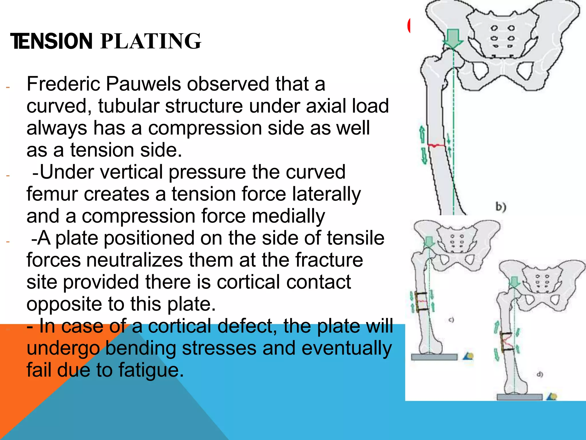 Plates in orthopaedics.pptx
