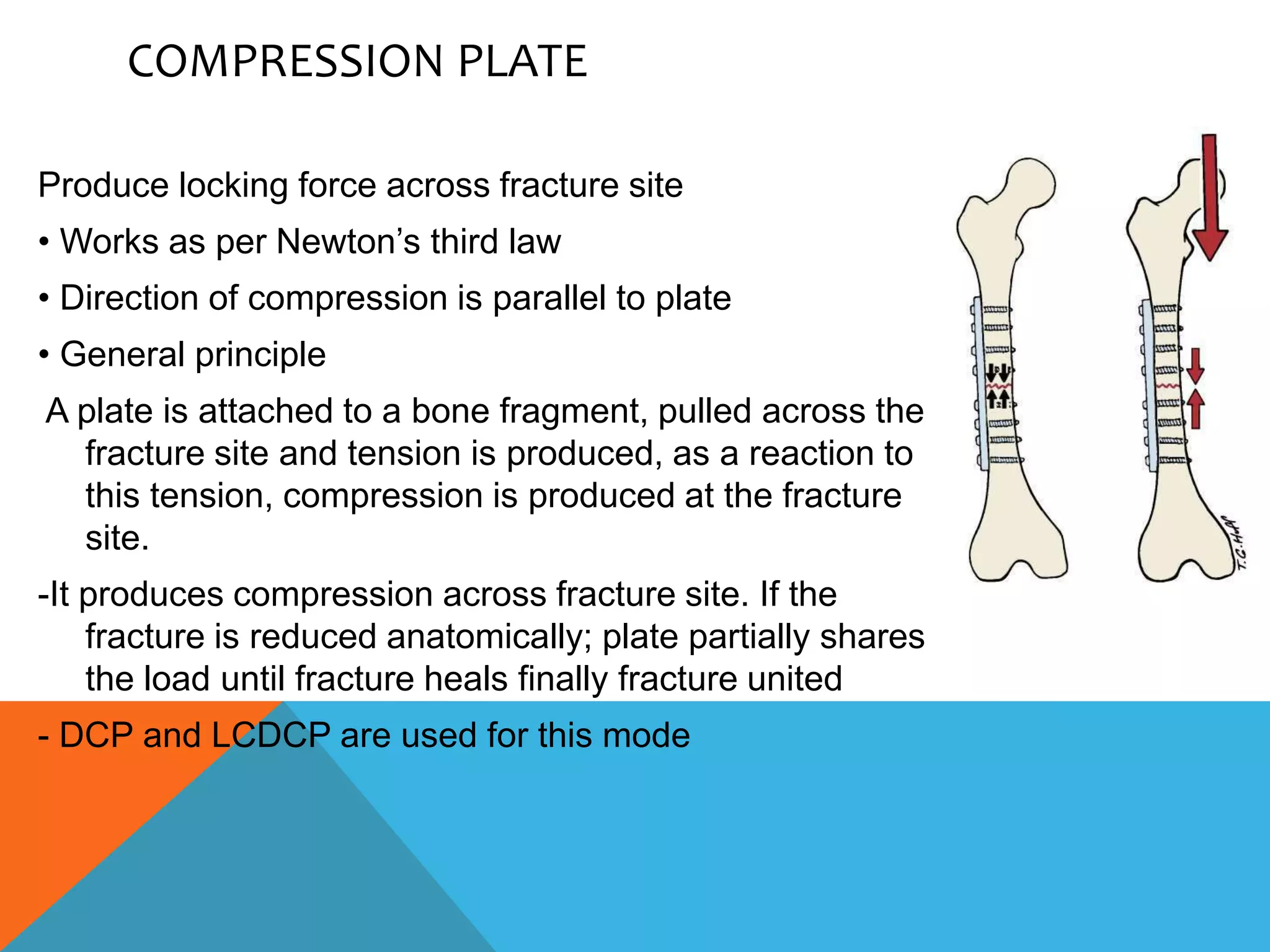 Plates in orthopaedics.pptx