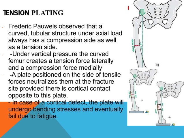 Plates in orthopaedics.pptx | First Aid | Injuries