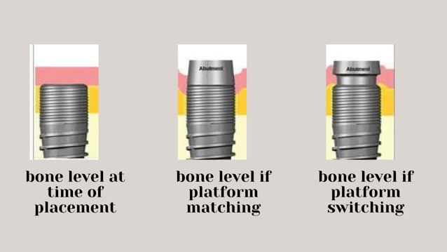 Platform switching in Implant dentistry.pdf