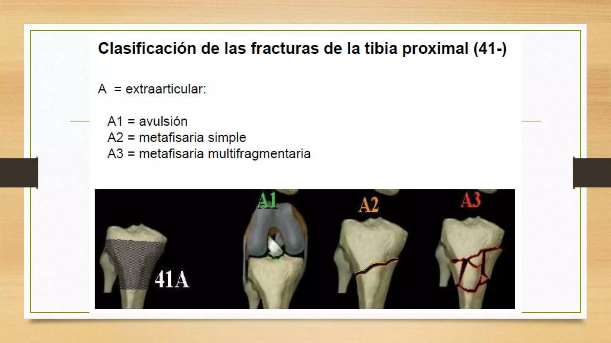 fractura de Platillo tibial | PPTX