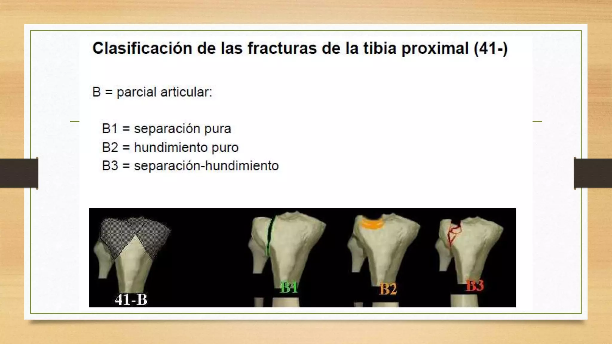 fractura de Platillo tibial | PPTX