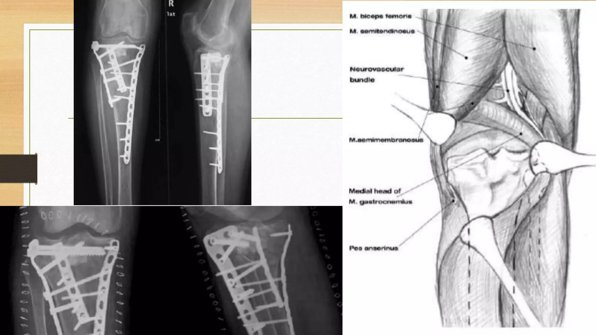 fractura de Platillo tibial | PPTX