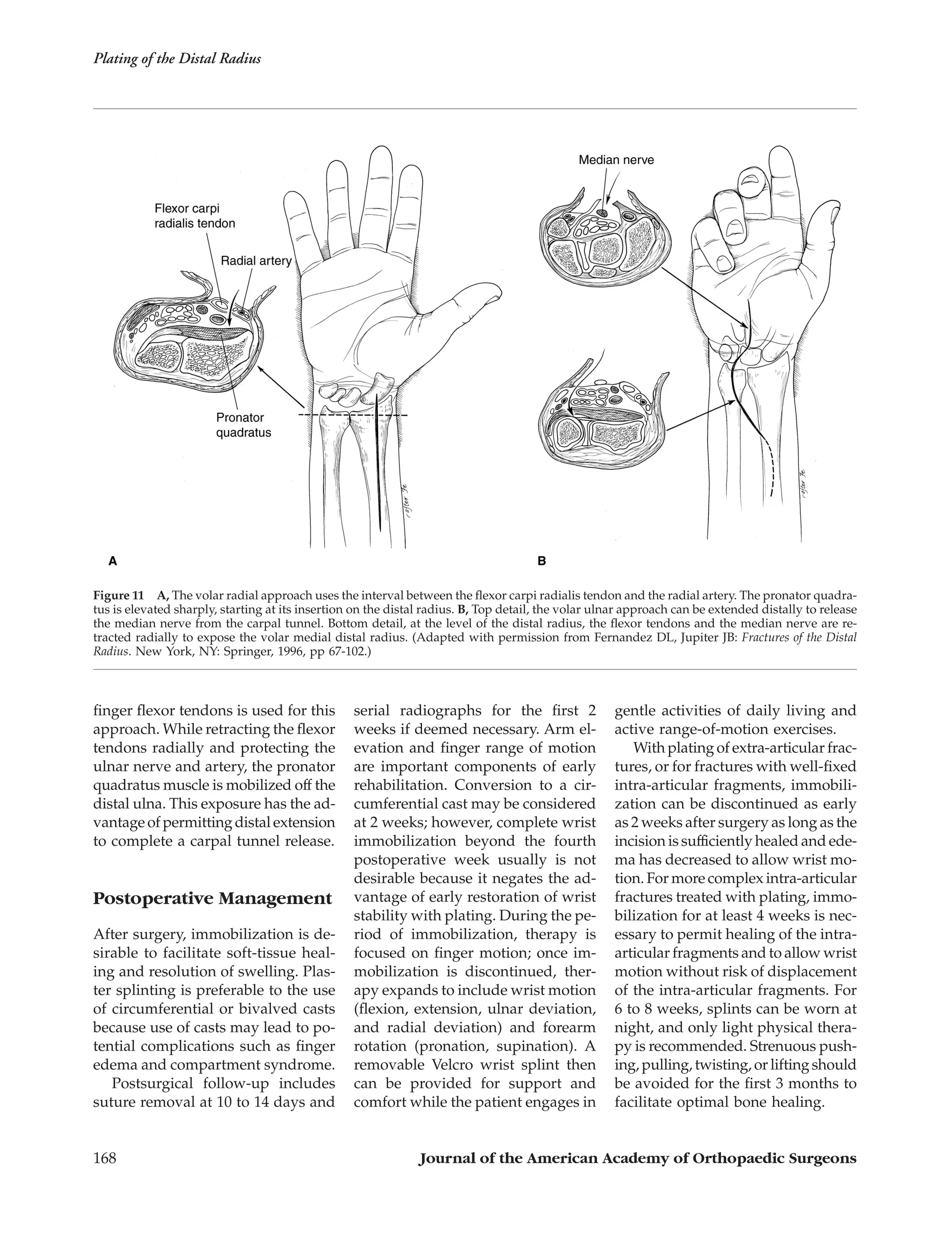 Plating of the distal radius | PDF