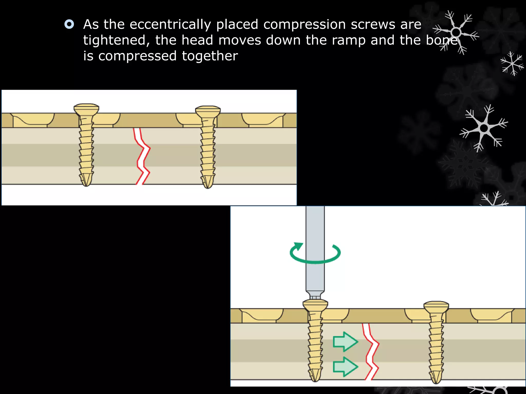 Plating systems and principles of fixation in maxillofacialtrauma | PPTX