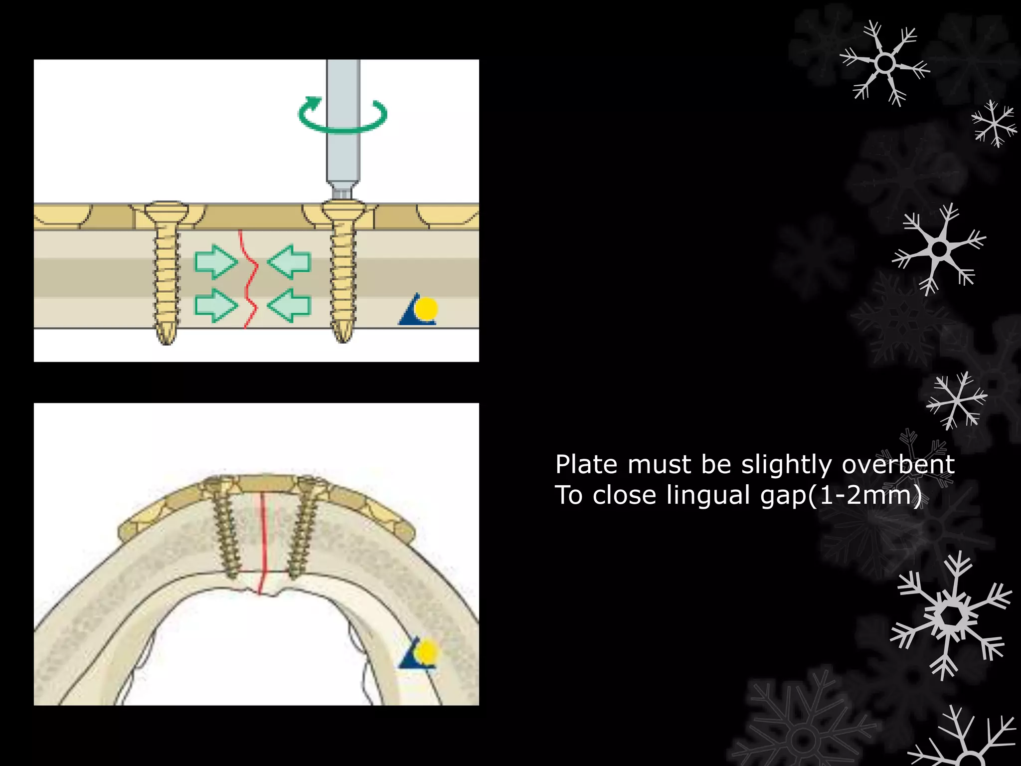 Plating systems and principles of fixation in maxillofacialtrauma | PPTX