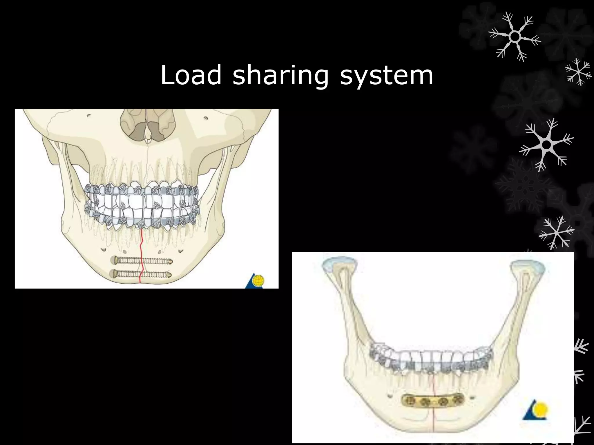 Plating systems and principles of fixation in maxillofacialtrauma | PPTX