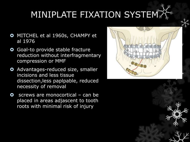 Plating systems and principles of fixation in maxillofacialtrauma ...