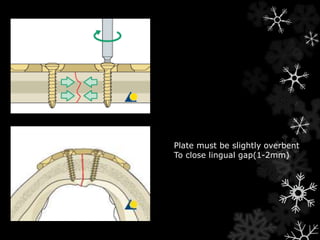 Plating systems and principles of fixation in maxillofacialtrauma | PPTX