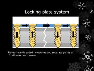 Plating systems and principles of fixation in maxillofacialtrauma | PPTX