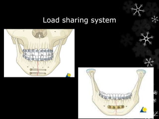 Plating systems and principles of fixation in maxillofacialtrauma | PPTX