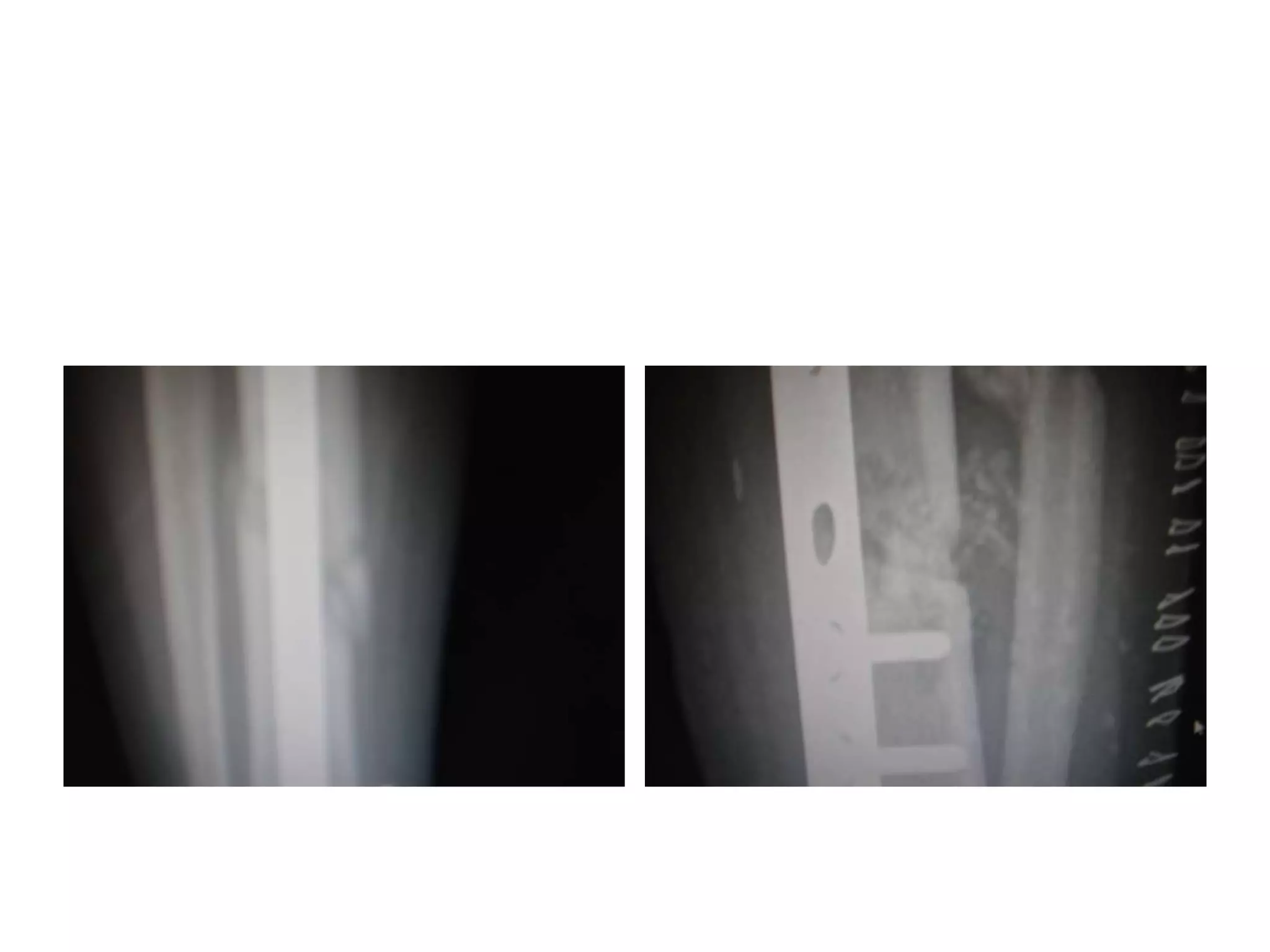 Plating tibia taif | PPTX