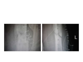 Plating tibia taif | PPTX