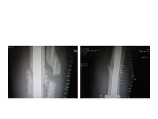 Plating tibia taif | PPTX