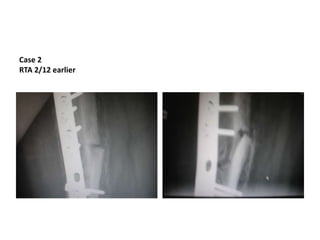 Plating tibia taif | PPTX