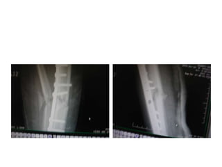 Plating tibia taif | PPTX