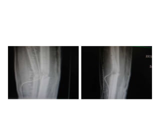 Plating tibia taif | PPTX