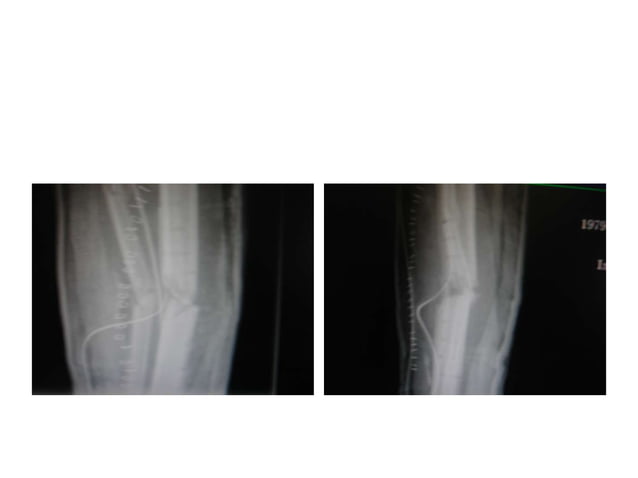 Plating tibia taif | PPTX