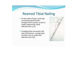 Plating tibia taif | PPTX