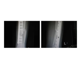 Plating tibia taif | PPTX