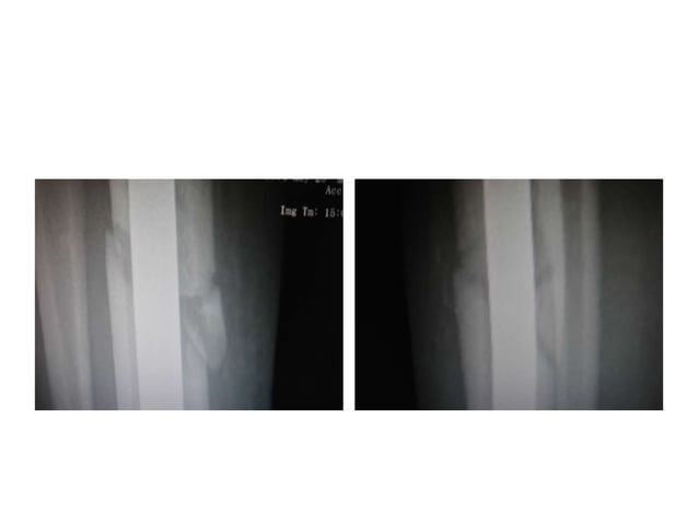 Plating tibia taif | PPTX