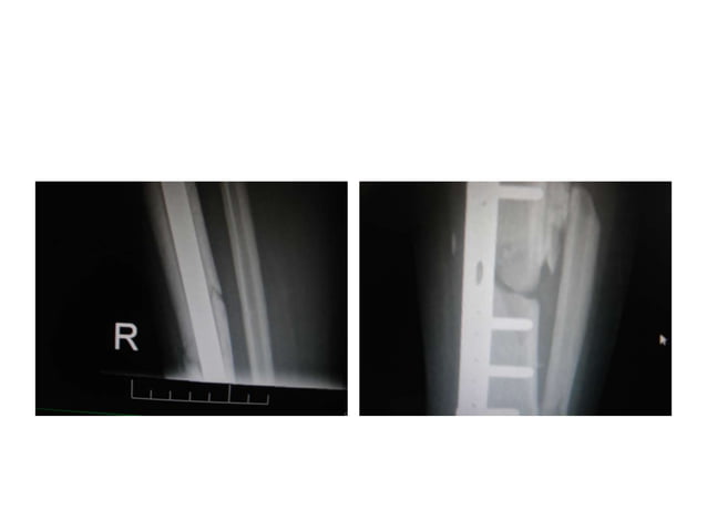 Plating tibia taif | PPTX