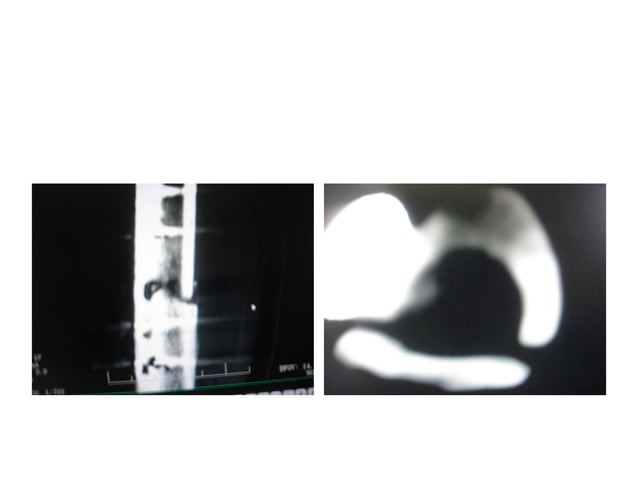 Plating tibia taif | PPTX