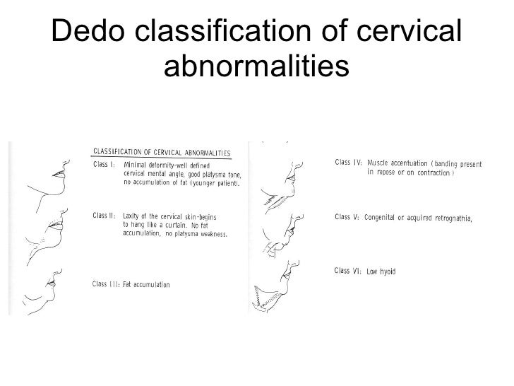 Facelift: Platysmal Muscular Suspension