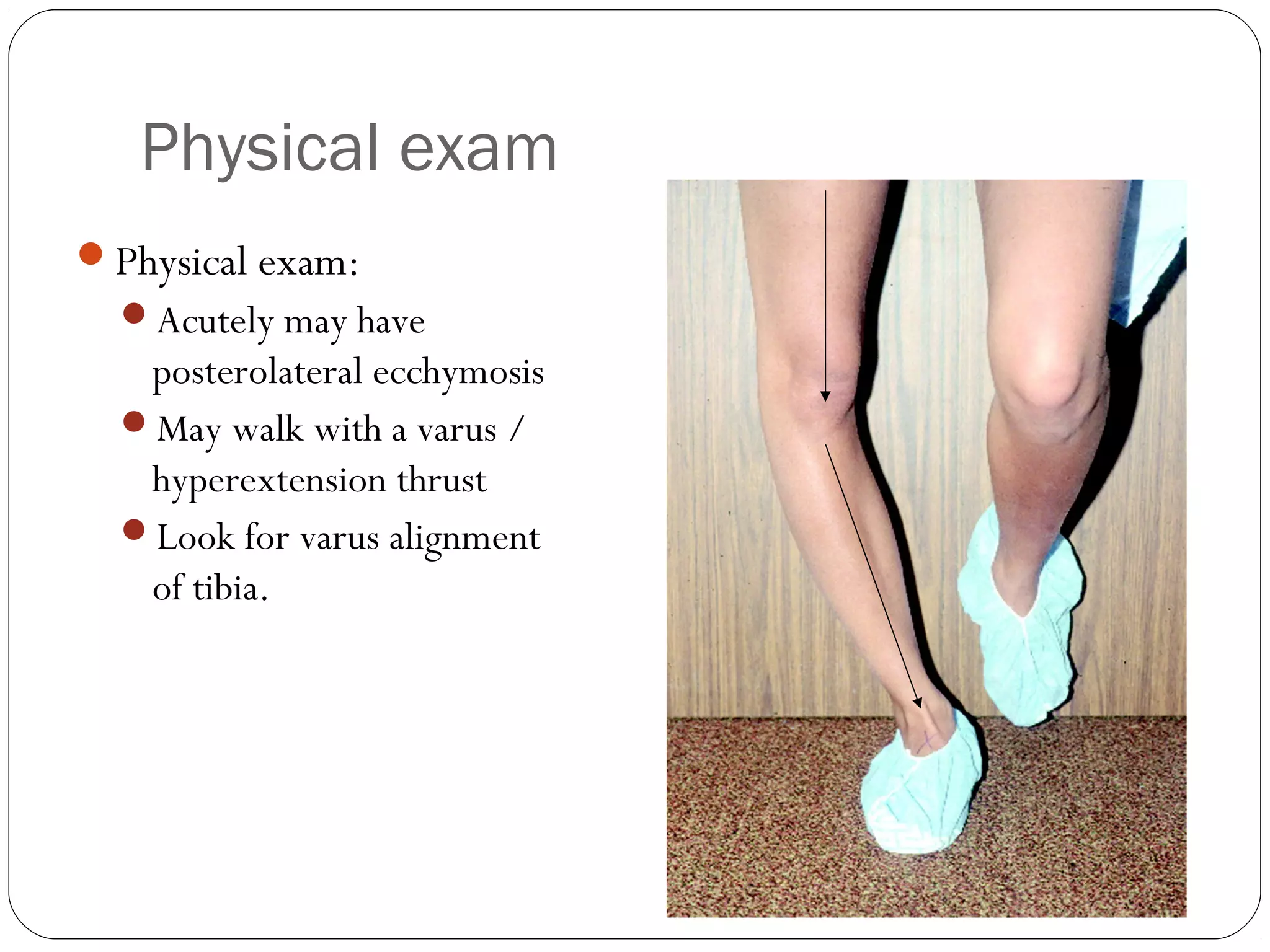 Posterolateral corner injuries of knee joint | PPT