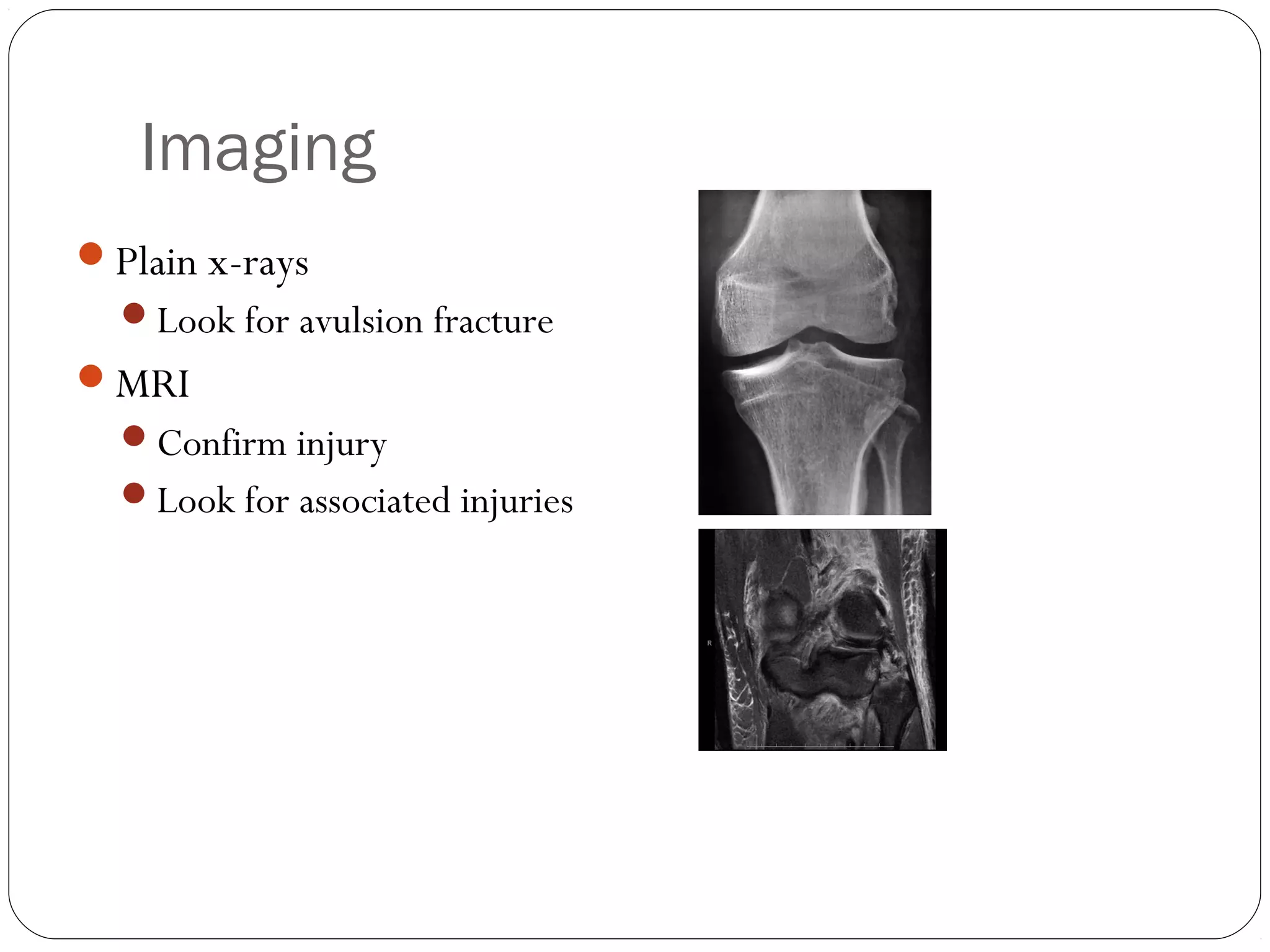 Posterolateral corner injuries of knee joint | PPT