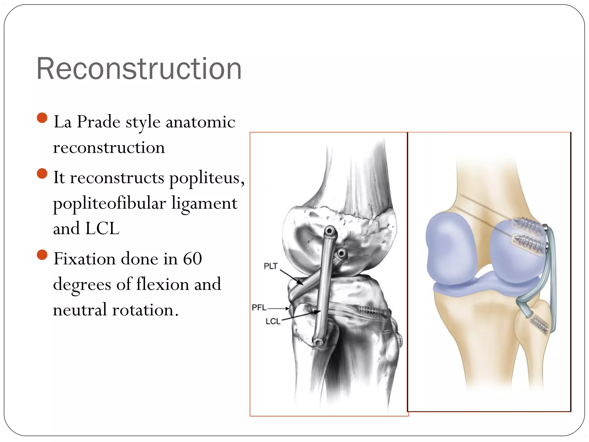 Posterolateral corner injuries of knee joint | PPT
