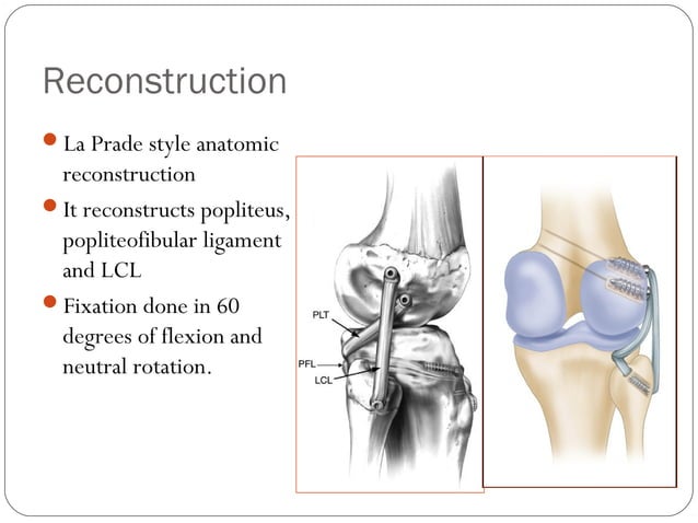Posterolateral corner injuries of knee joint | PPT | Death, Injury, or ...