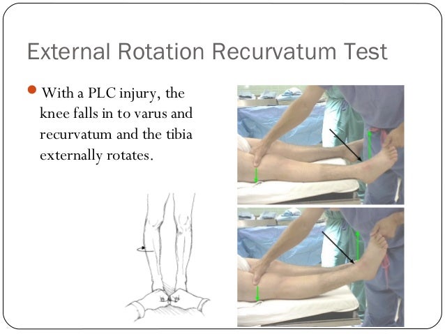 Posterolateral corner injuries of knee joint