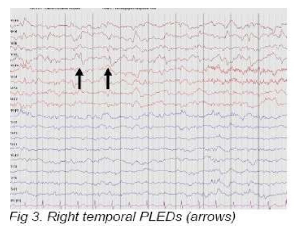 Periodic Lateralizing Epileptiform Discharges