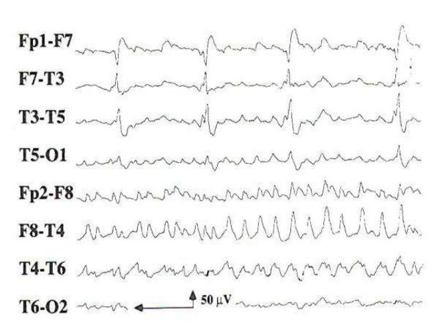 Periodic Lateralizing Epileptiform Discharges