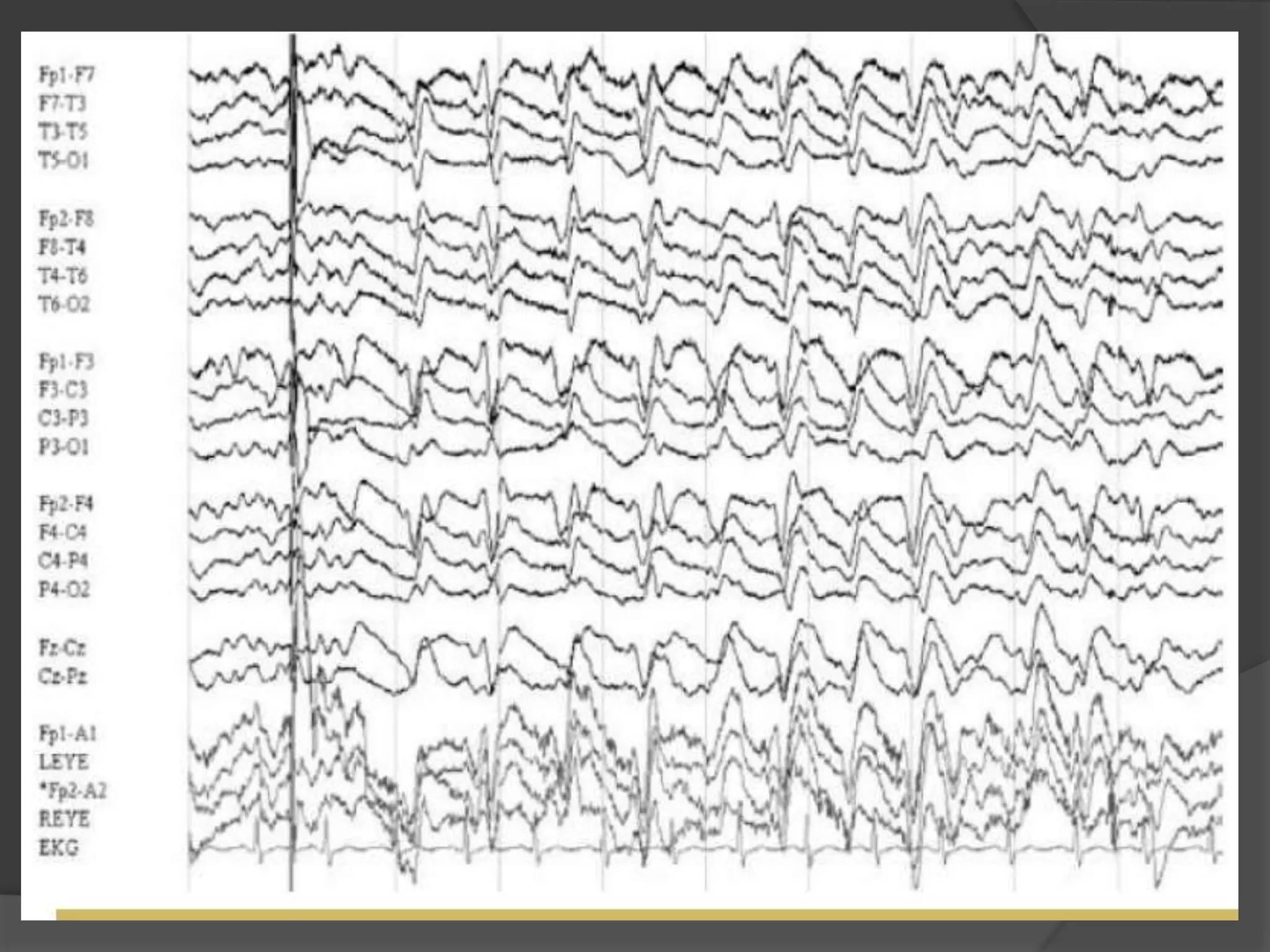 Periodic lateralized epileptiform discharges | PPTX