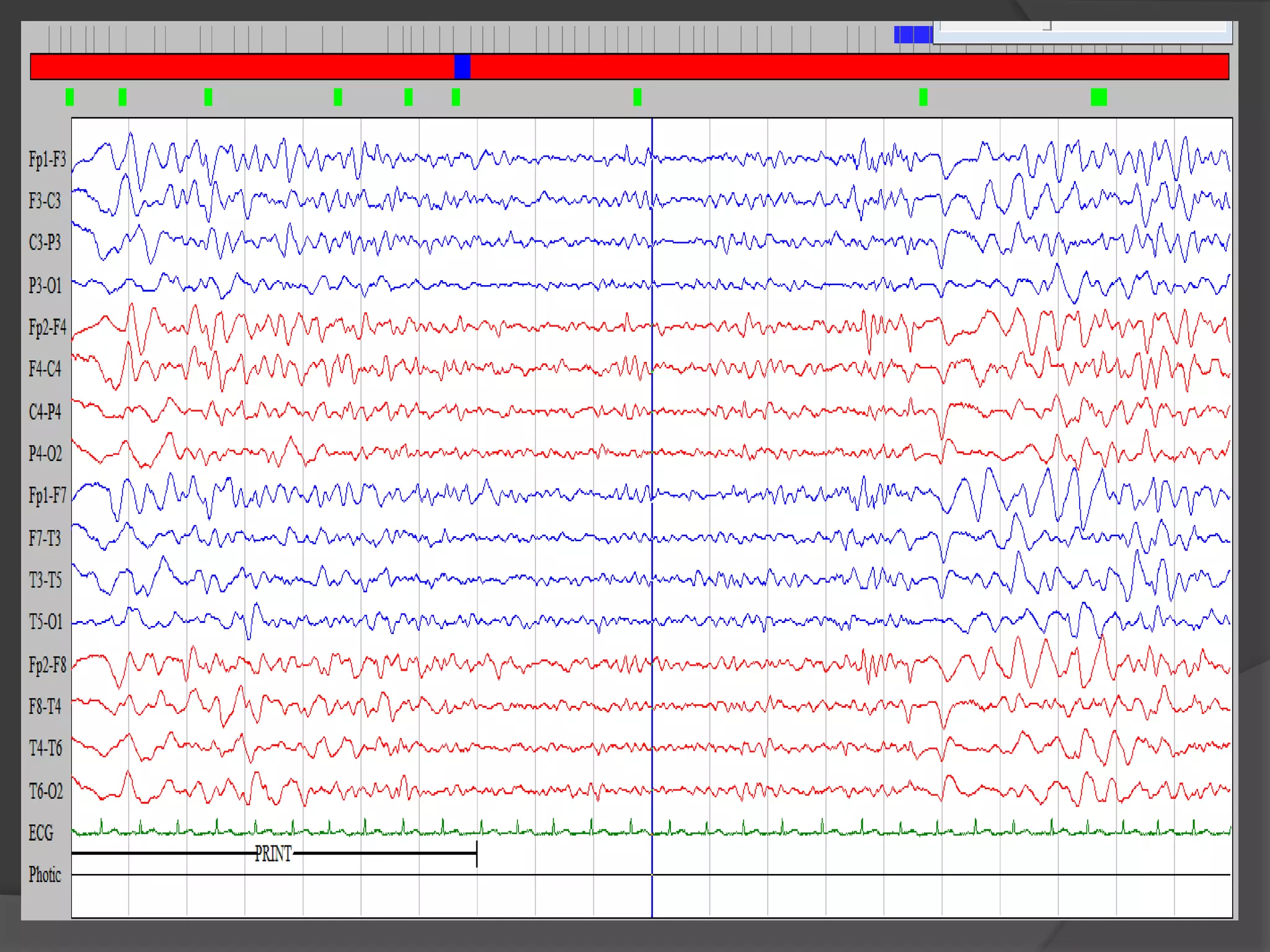 Periodic lateralized epileptiform discharges | PPTX