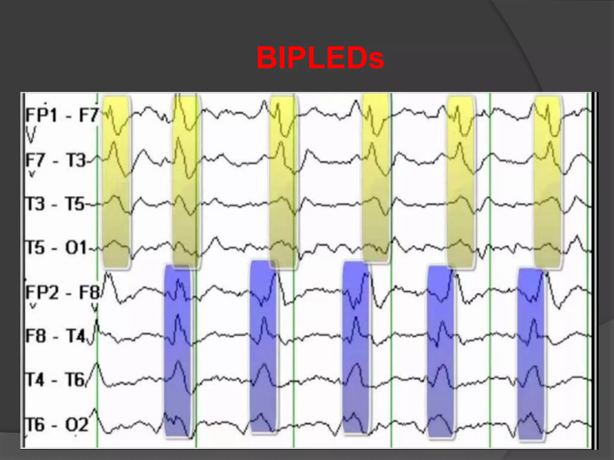 Periodic lateralized epileptiform discharges | PPTX