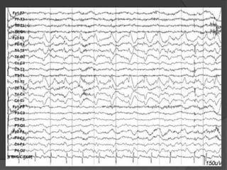 Periodic lateralized epileptiform discharges | PPTX